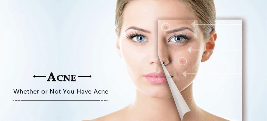 Acne Archives | Acne Treatment at USA, AU