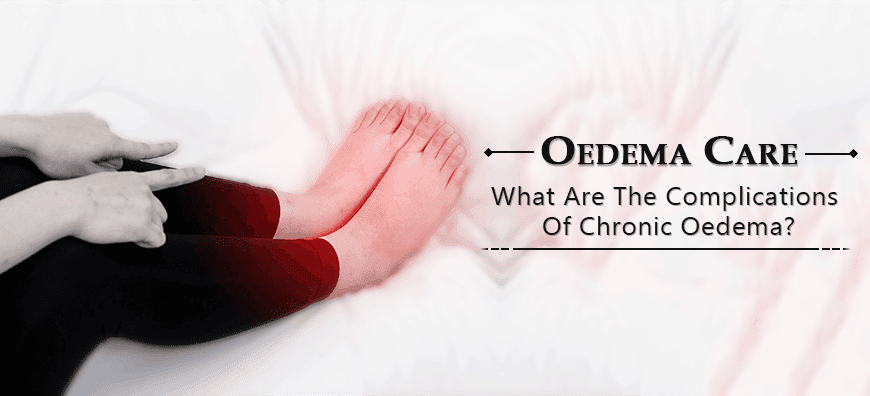 What is Oedema? - What causes edema? Types,Symptoms & Treatment